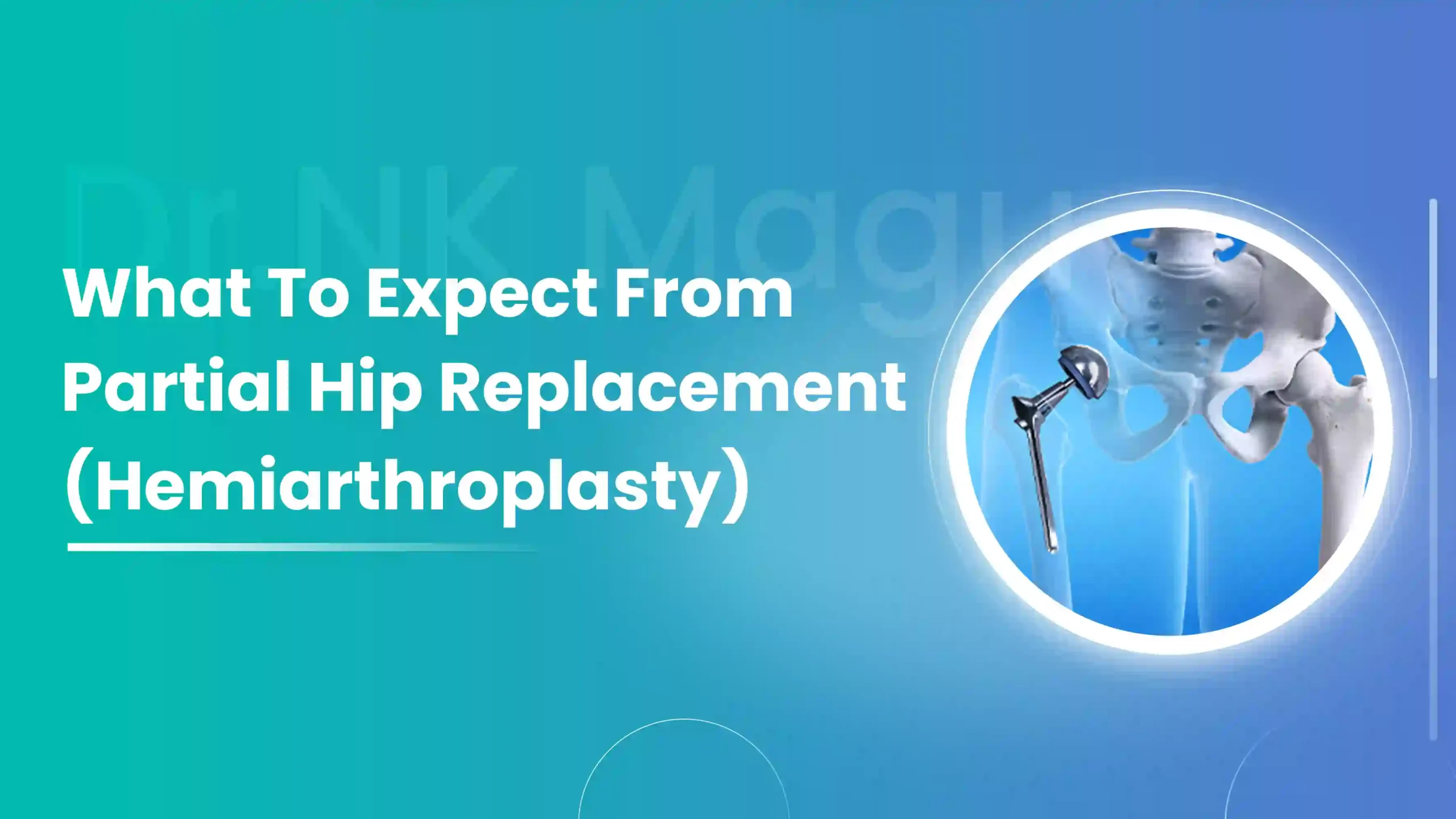 Hemiarthroplasty: Types, Procedure & Complications